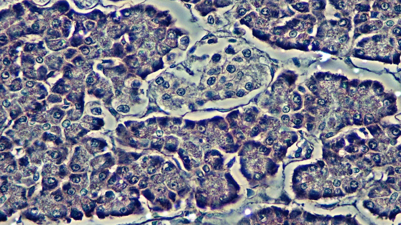 Cell Therapy | Breakthrough T1D